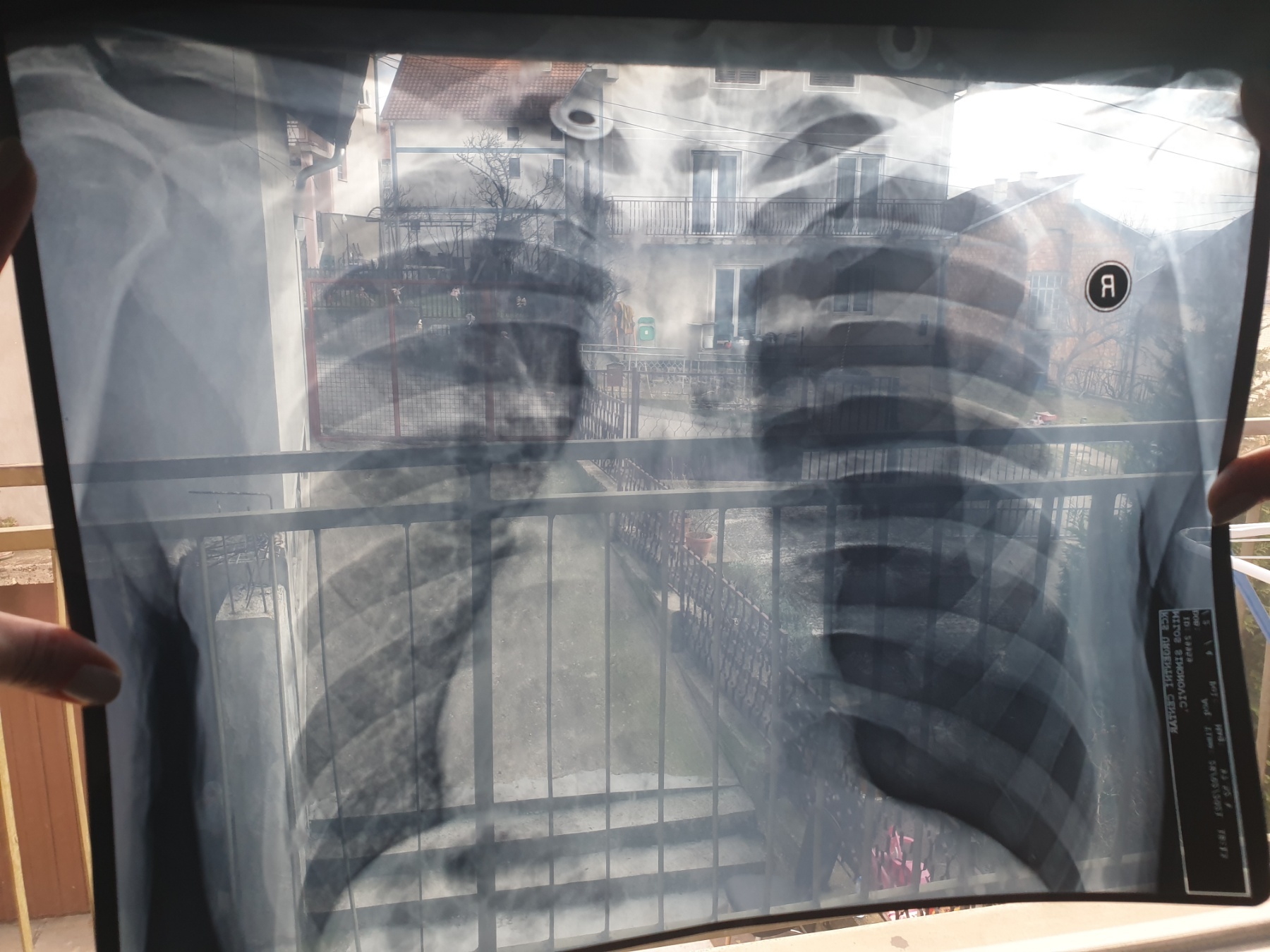 personal/pneumothorax · joe-antognini joe-antognini.github.io · Discussion #24 · GitHub