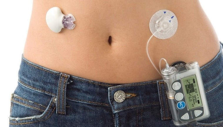 Monitoraggio glicemico continuo: ecco il nuovo sistema approvato dalla FDA